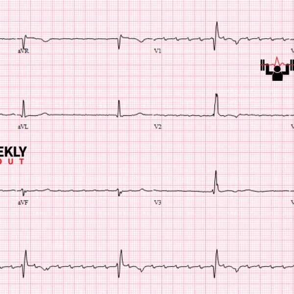 Complete Heart Block – ECG Weekly