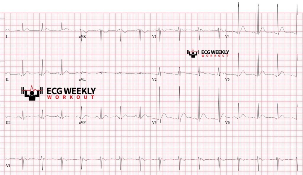Differential Diagnoses: ST segment elevation and short QTc interval ...