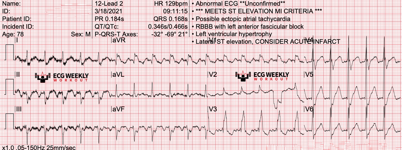Rhythm Interpretation: atrial tachyarrhythmia review part 2/2 – ECG Weekly