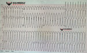 STAT ECG Diagnoses: using the ECG in cases of wide complex tachycardia to diagnose ventricular ...
