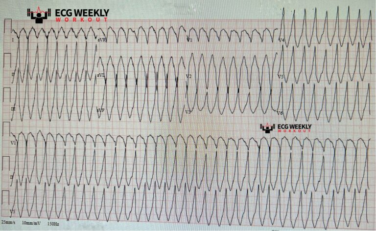 STAT ECG Diagnoses: using the ECG in cases of wide complex tachycardia to diagnose ventricular ...