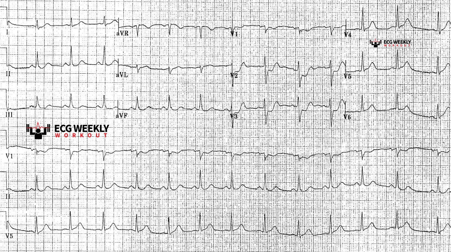 STAT ECG Diagnoses: can you have a STEMI without any ST segment elevation on the 12 lead ECG ...