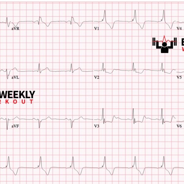 RBBB – ECG Weekly