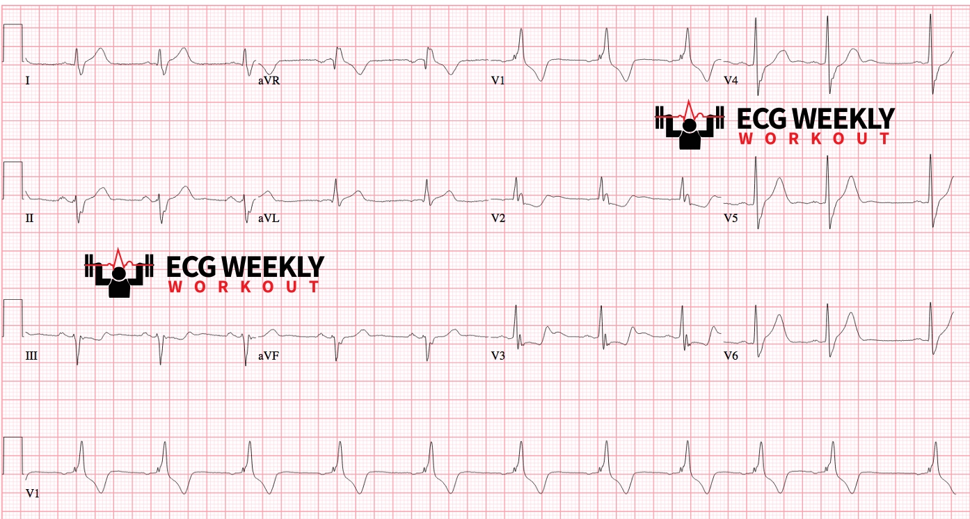 STAT ECG Diagnoses: findings of occlusion MI in patients with right bundle branch block (RBBB ...