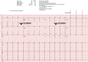 STAT ECG Diagnoses: review of the causes of T wave inversions and ...