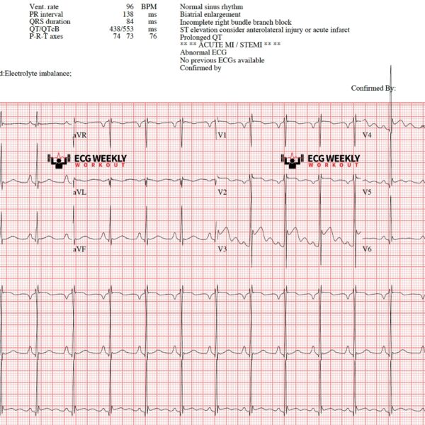Wellens’ syndrome – ECG Weekly