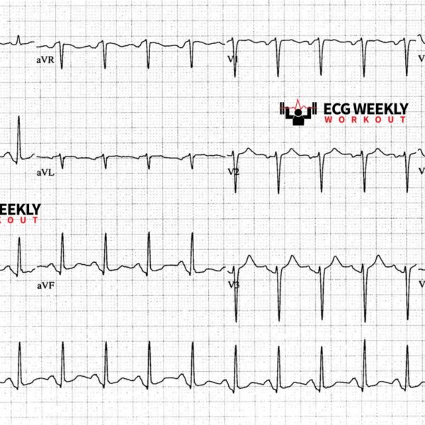 Pericarditis – ECG Weekly