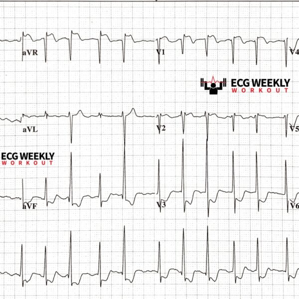 aVR – ECG Weekly