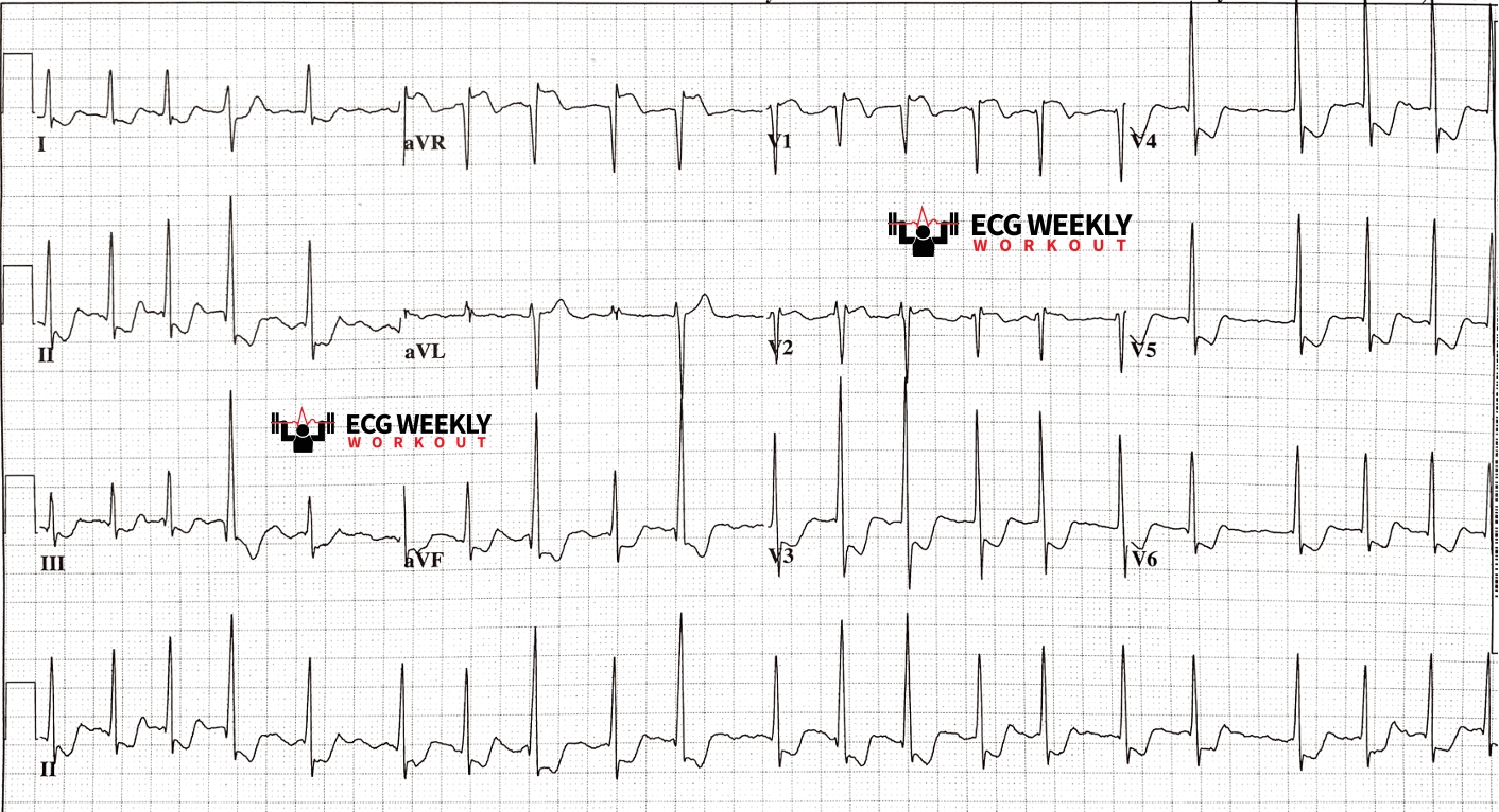 Potpourri of cases: diffuse subendocardial myocardial ischemia with ST segment elevation in aVR ...