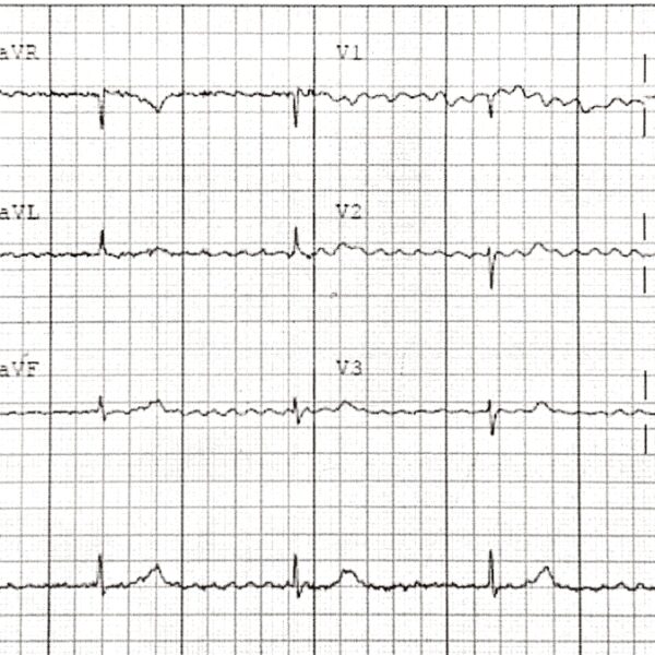 Sgarbossa Criteria – ECG Weekly