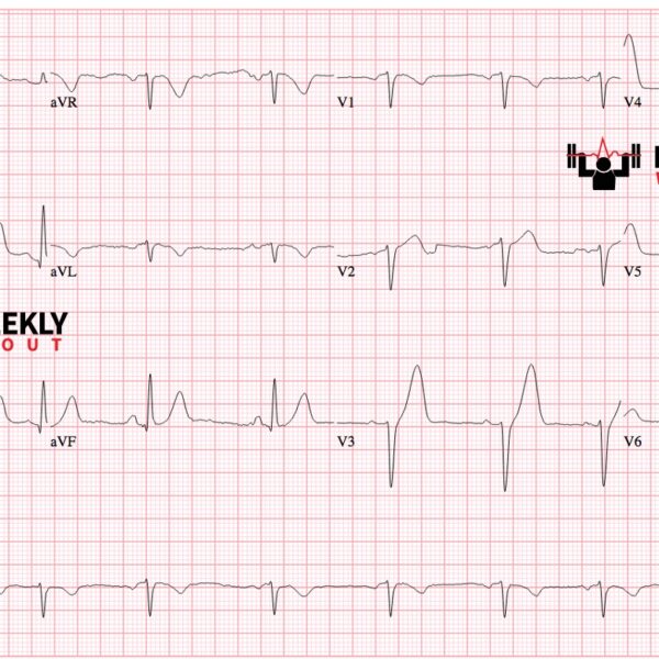 inferior STEMI – ECG Weekly