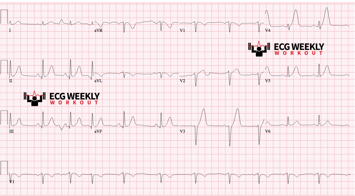 ECG Basics and Fundamentals: subtle early signs of acute cardiac ...