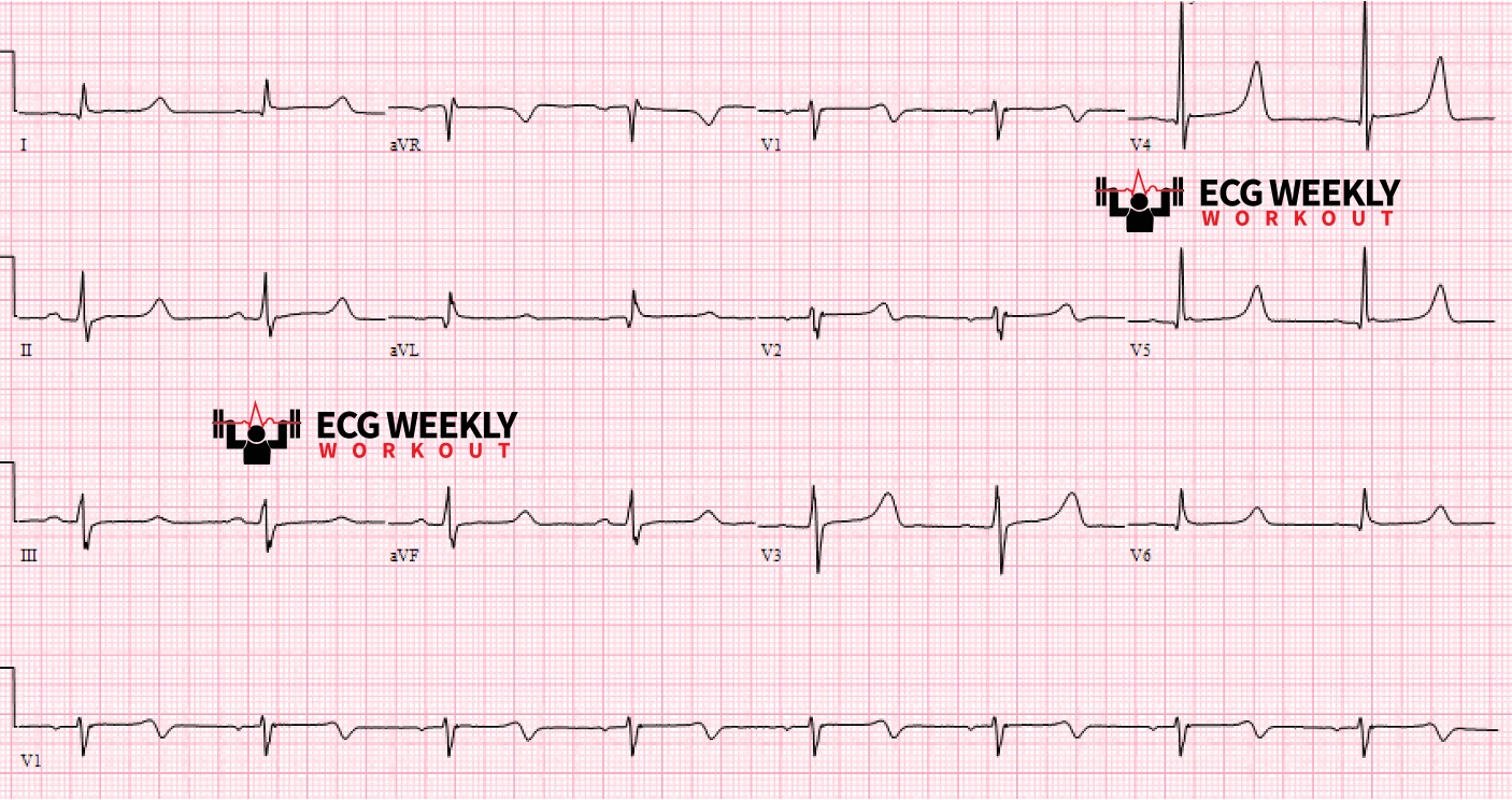Differential DIagnoses: AV blocks, prolonged QTc intervals, T wave ...