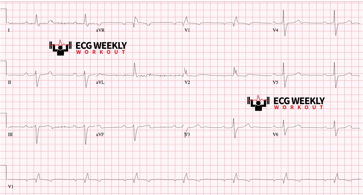 Differential Diagnoses: narrow complex irregular tachycardia, short QTc ...
