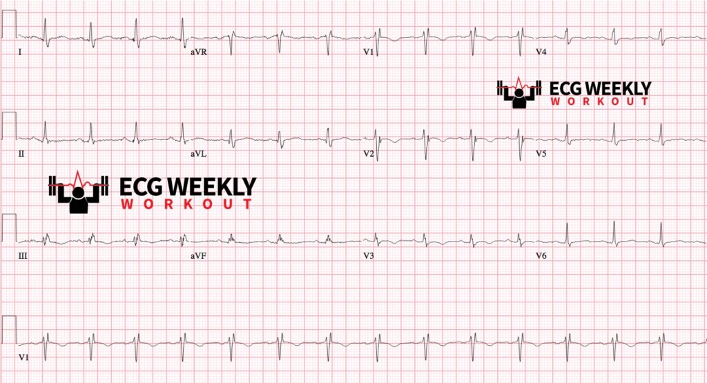 Differential Diagnoses: AV blocks, tachyarrhythmias, and what you need ...