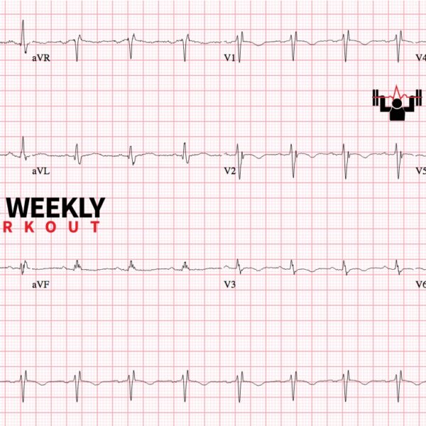 PVCs – ECG Weekly