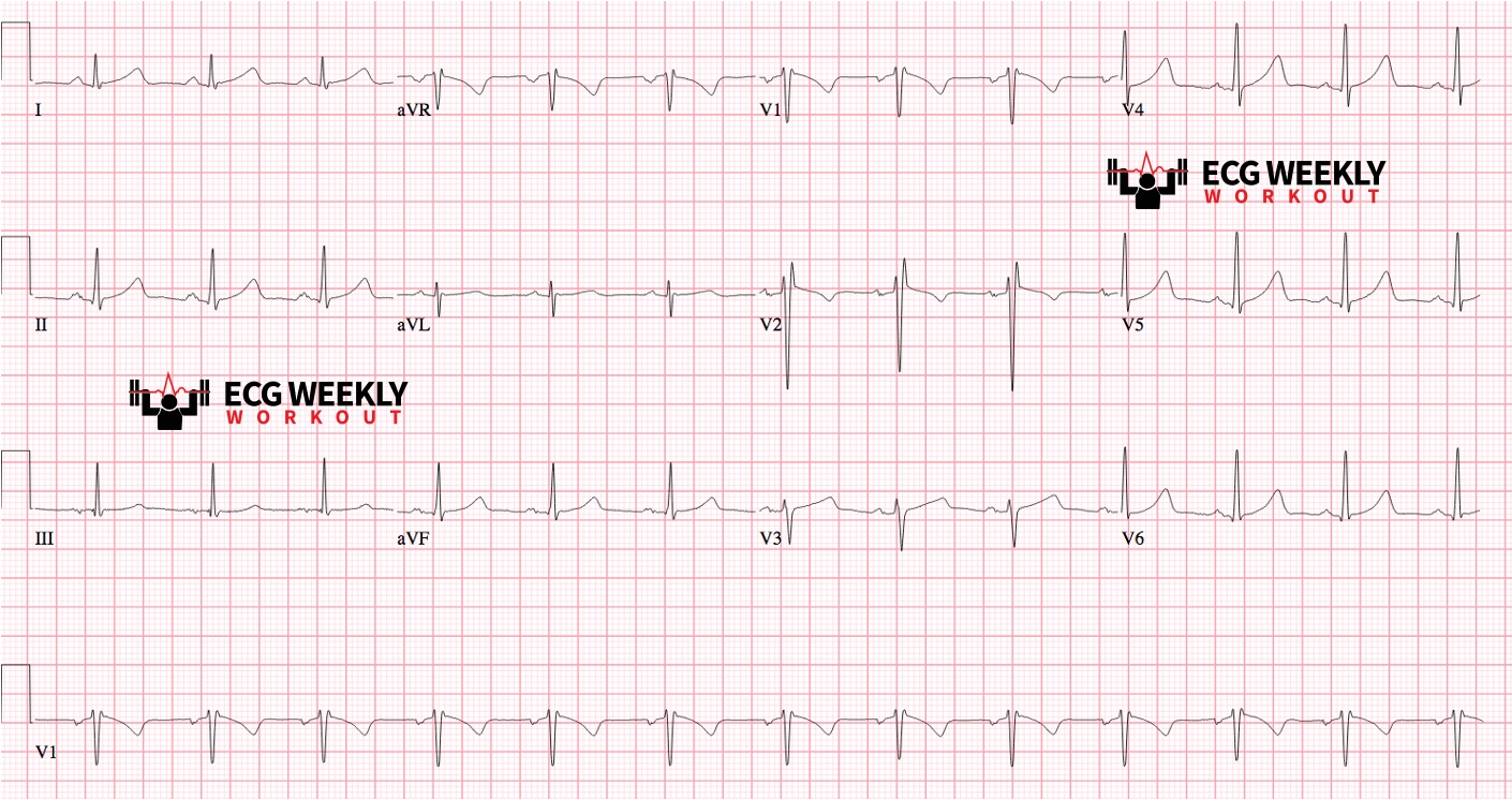ECG Basics and Fundamentals: T wave inversions and the importance of ...
