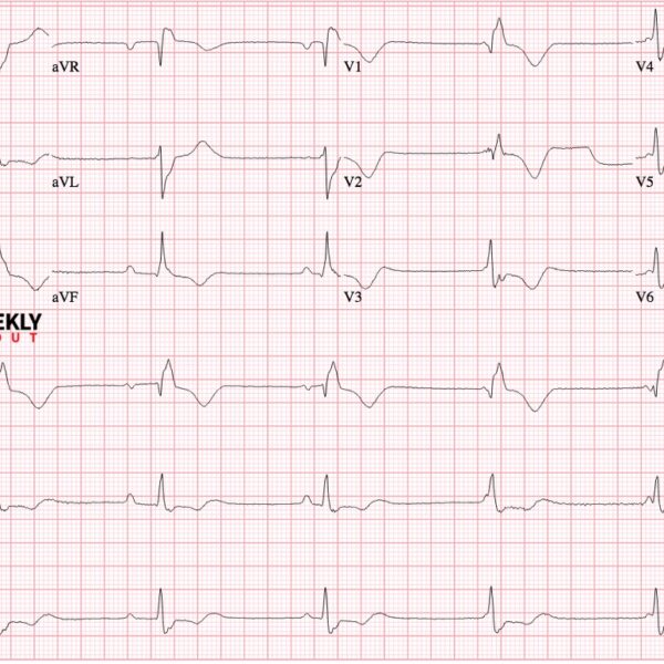 Complete Heart Block – ECG Weekly