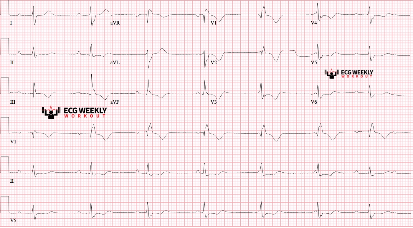 Bradyarrhythmias: rash, a history of tick bite, and slow regular ...