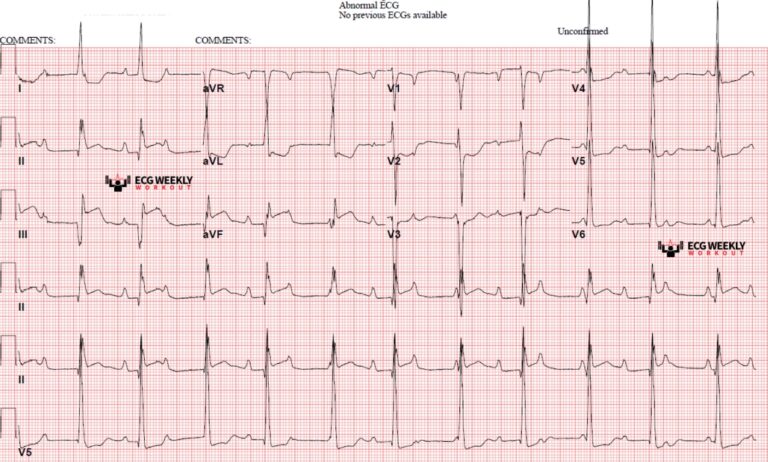 Bradyarrhythmias: the types of acute myocardial infarction associated with heart block – ECG Weekly