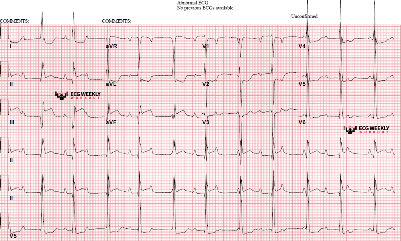 Bradyarrhythmias: the types of acute myocardial infarction associated ...