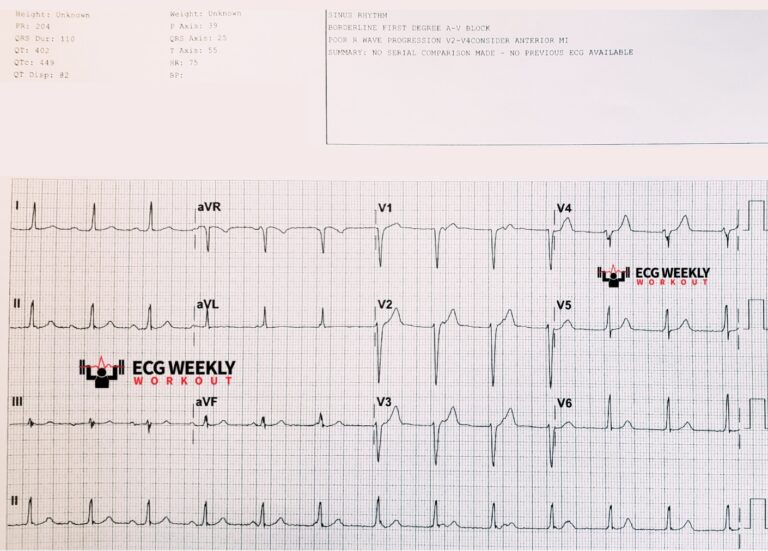 STAT ECG Diagnoses: Isorhythmic AV Dissociation and Complete Heart Block – ECG Weekly