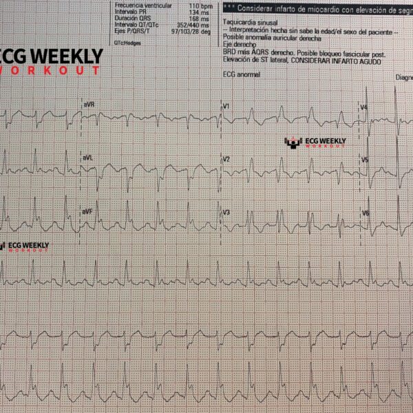 STEMI mimics – ECG Weekly