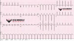 Narrow Complex Tachycardia: sinus tachycardia, atrial flutter, or SVT? – ECG Weekly