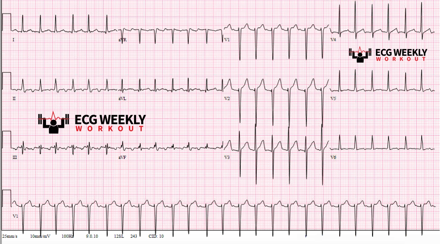 Narrow Complex Tachycardia Sinus Tachycardia Atrial Flutter Or Svt Ecg Weekly