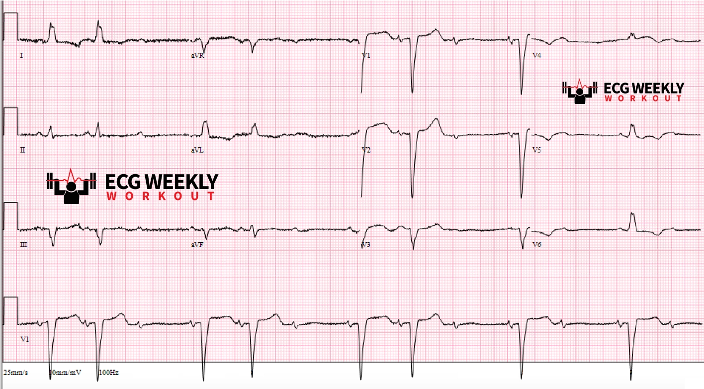 Bradydysrhythmia: An irregular rhythm with grouped or clumped beats ...