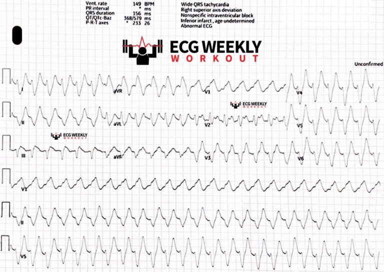Differential Diagnoses: what you gotta know about regular wide complex ...
