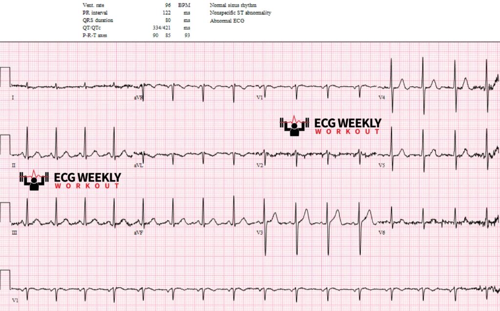 ECG Basics and Fundamentals: the earliest evidence of cardiac ischemia ...