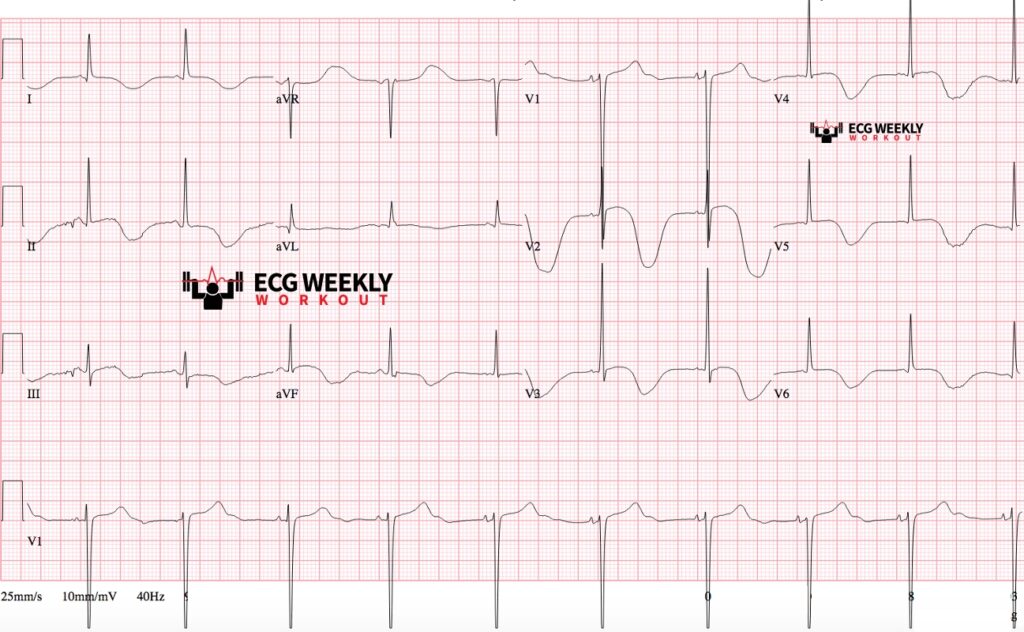 Potpourri of cases: differential diagnoses for long QTc intervals, diagnosing occlusion MI in ...