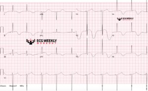 Potpourri of cases: differential diagnoses for long QTc intervals, diagnosing occlusion MI in ...