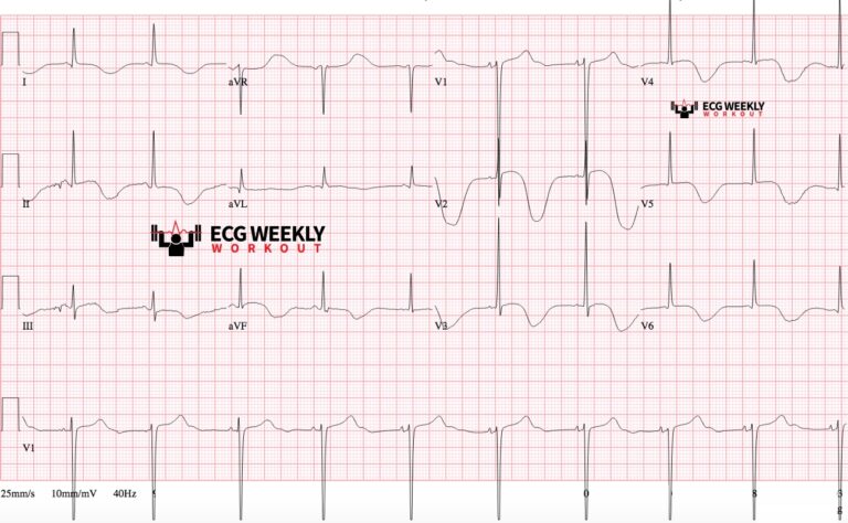 Potpourri of cases: differential diagnoses for long QTc intervals, diagnosing occlusion MI in ...