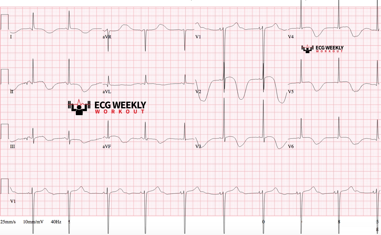 Potpourri of cases: differential diagnoses for long QTc intervals, diagnosing occlusion MI in ...
