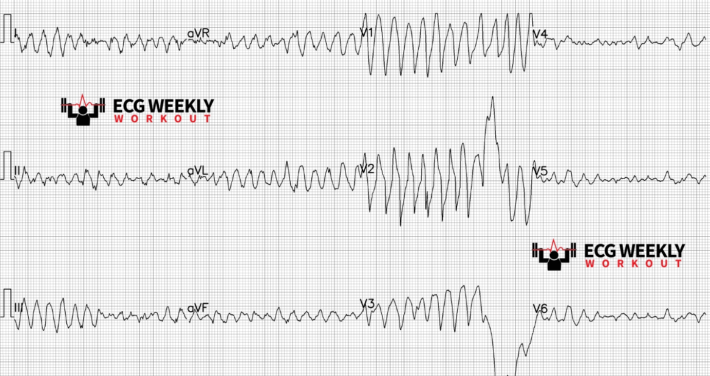 Potpourri of cases: generic polymorphic ventricular tachycardia vs ...