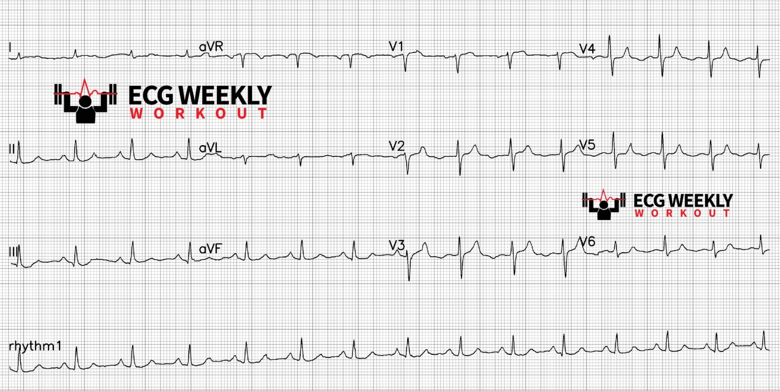 ECG Basics & Fundamentals: the value of clinical decisions instruments and what to do when ...
