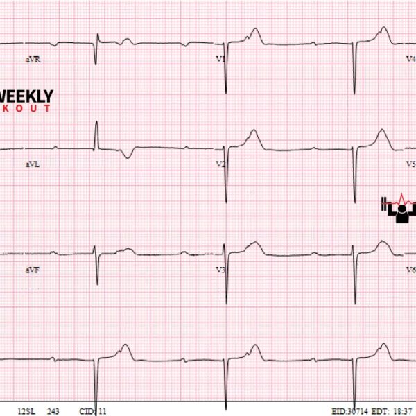 Mobitz II AV block – ECG Weekly