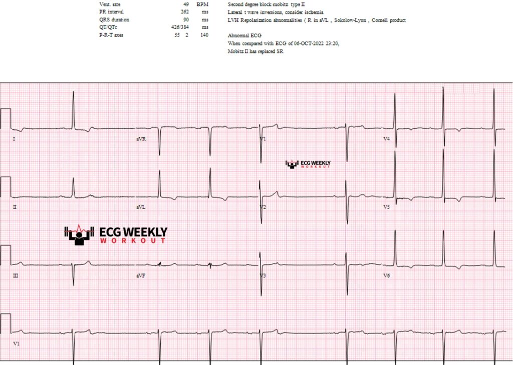 ECG Basics and Fundamentals: causes of pauses or clumped/grouped beats ... ECG Basics and Fundamentals: causes of pauses or clumped/grouped beats ...