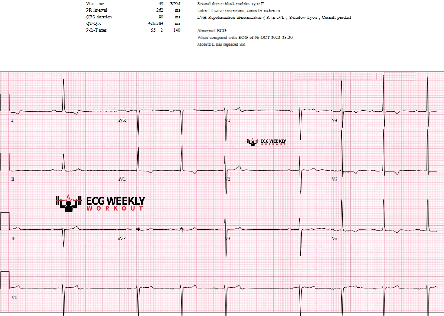 ECG Basics and Fundamentals: causes of pauses or clumped/grouped beats ...