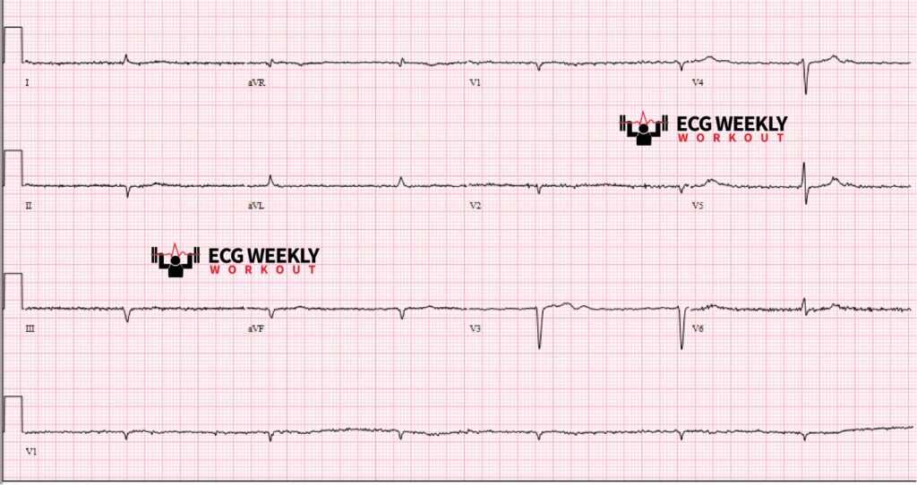 STAT ECG Diagnoses: differential diagnoses for low voltage QRS ...