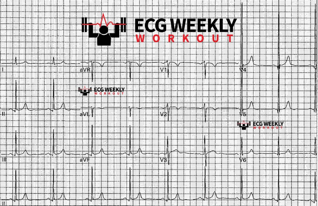 STAT ECG Diagnoses: the significance of inverted U waves – ECG Weekly