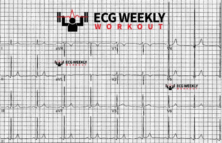 STAT ECG Diagnoses: the significance of inverted U waves – ECG Weekly