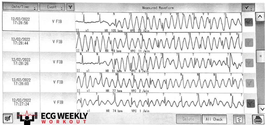 Rhythm interpretation: when to worry about cardiac rhythm strips – ECG ...