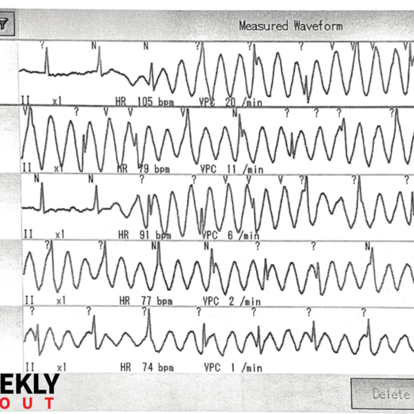 Ventricular fibrillation – ECG Weekly