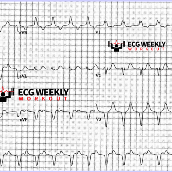 Diffuse ST elevation – ECG Weekly