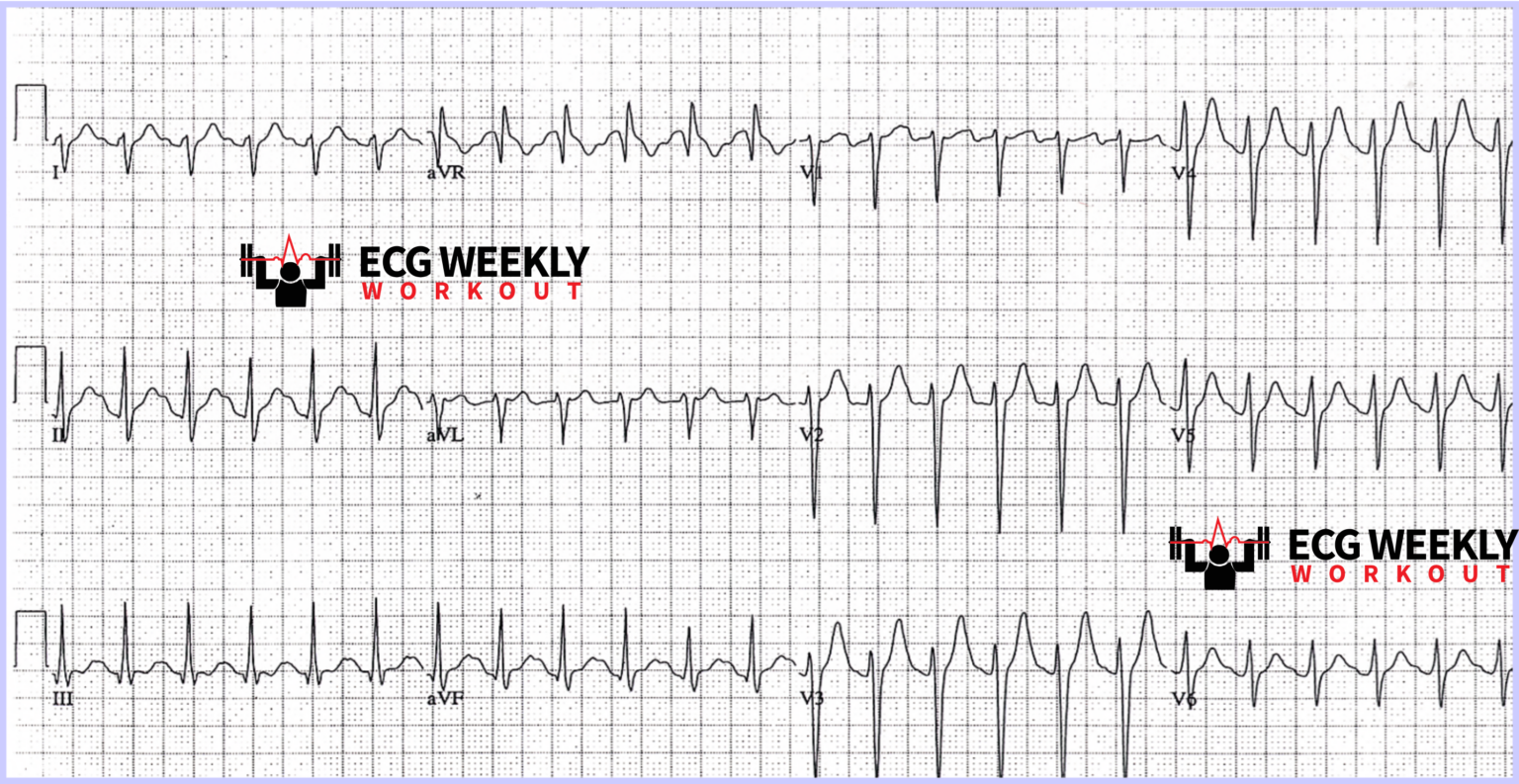 Must know ECGs you will see on board exams and have to recognize in ...