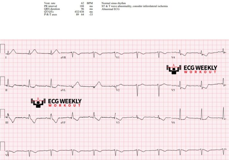 STAT ECG Diagnoses: early ECG signs of cardiac ischemia and acute ...