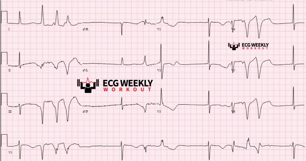 Several ECG cases from UMEM that highlight the importance of pattern recognition and a good ...